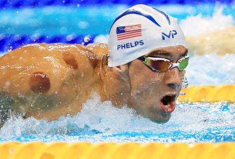 Interest in “cupping” therapy spikes after Michael Phelps’ gold win ...