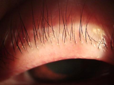 Eyelash Mites Blepharitis NHS